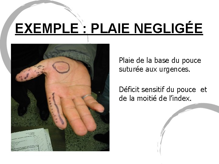 PLAIES DE LA MAIN PANARIS PHLEGMONS Dr Alexandre