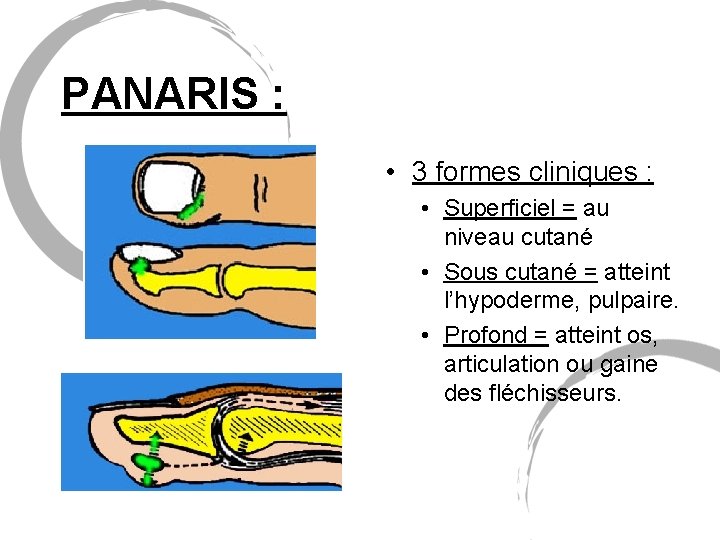 PLAIES DE LA MAIN PANARIS PHLEGMONS Dr Alexandre