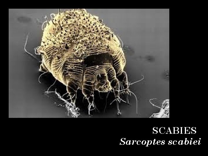 SCABIES Sarcoptes scabiei Scabies is an intensely itching