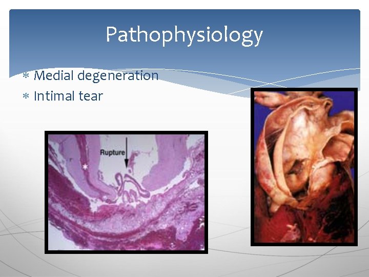 Pathophysiology Medial degeneration Intimal tear Epidemiology Knowledge ...