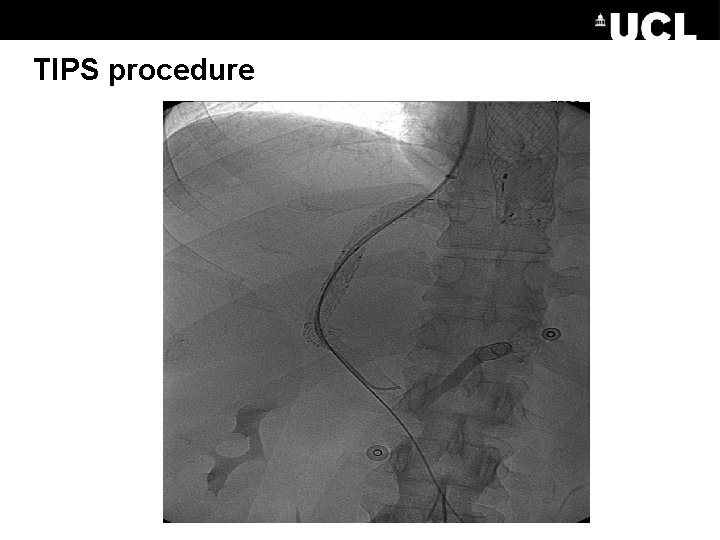 DANIS stent for Variceal Bleeding UK Experience and