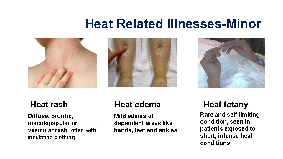 Heat and Human Health Dr Akshay Kumar Assistant