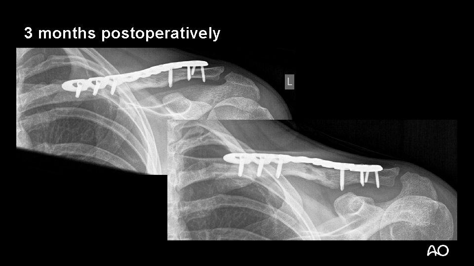Clavicle Overview Management summary Presenters name Content prepared
