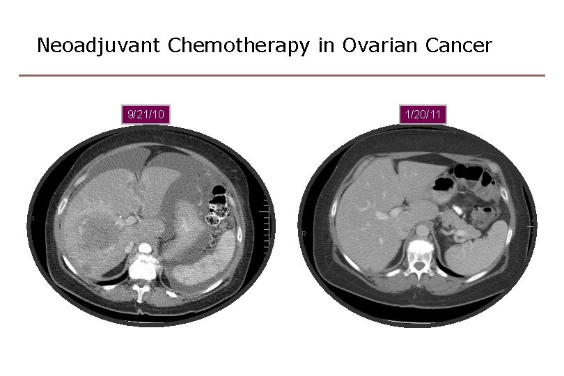 Ovarian Cancer Standards of Care and New Opportunities