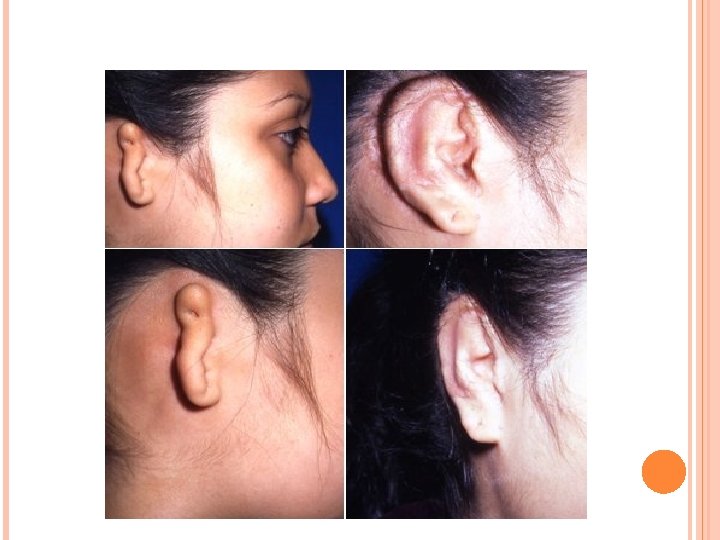 UNIDAD 6 PABELLON AURICULAR CONDUCTO AUDITIVO EXTERNO MALFORMACIONES