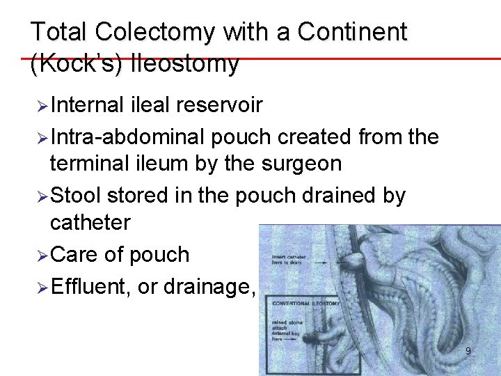 Nursing Care Interventions for Clients with Inflammatory Intestinal