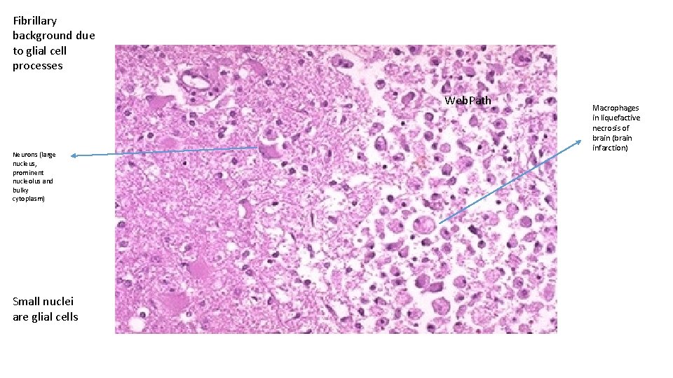 Fibrinoid necrosis Robbins Chronic inflammatory cells attacking the