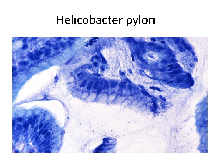 The H pylori Story Helicobacter pylori through the