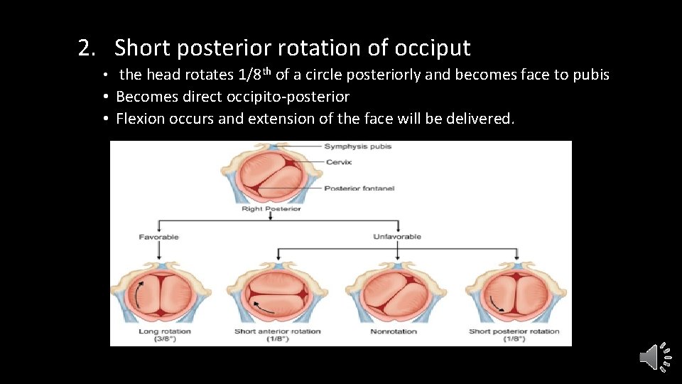 OCCIPITOPOSTERIOR FACE AND BROW PRESENTATION BY DR TAMER