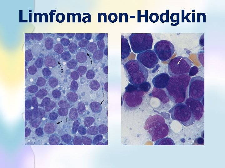 LIMFOMA MALIGNA Limfoma Maligna Keganasan primer jaringan limfoid