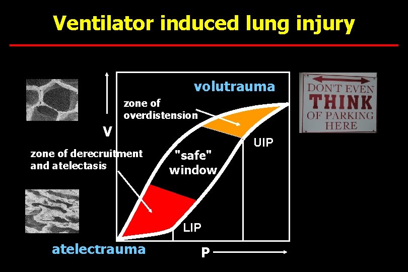 Recruitment and PEEP in ALIARDS Paolo Pelosi Department