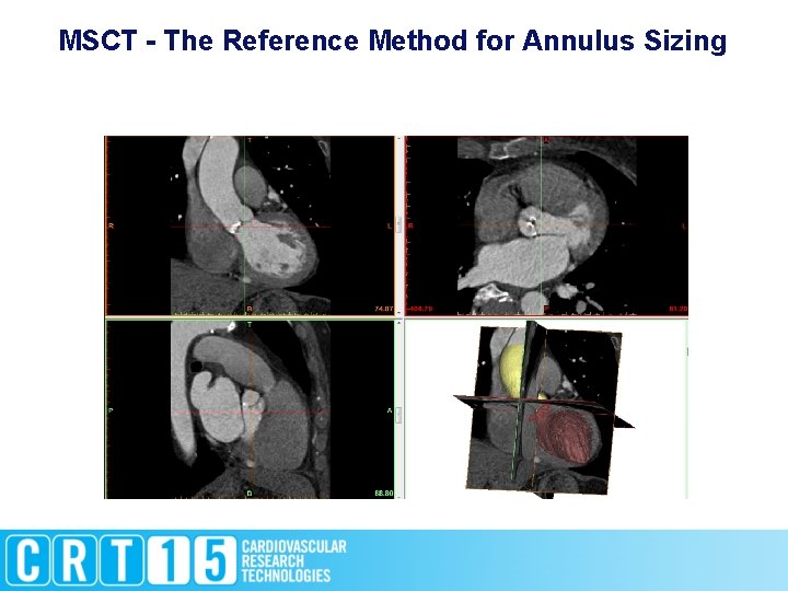 Optimizing Valve Sizing Role of CT vs Echo