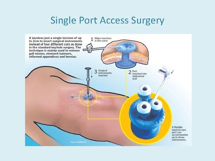 Laparoscopy Dr S Nishan Silva MBBS SHORT HISTORY