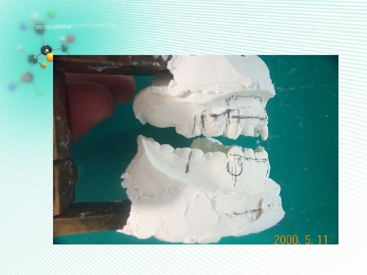 Construction bite Class 2 Class 3 2 Activator