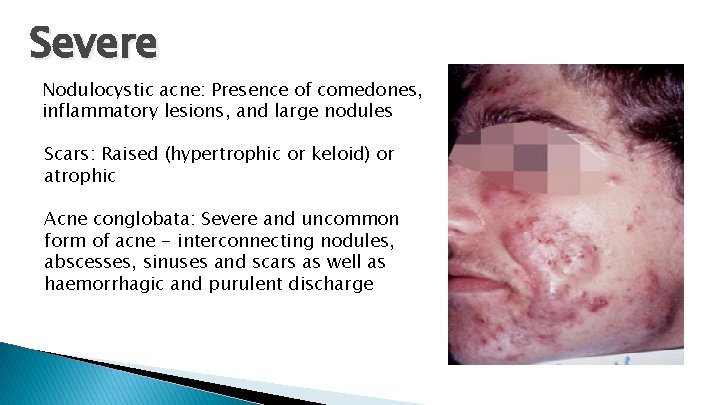 Acne Vulgaris Whats new Acne Vulgaris Acne is
