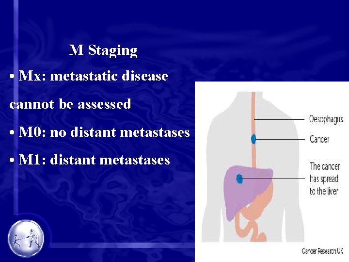 Oesophageal Cancer DR ASHOK B GALANDE M Ch