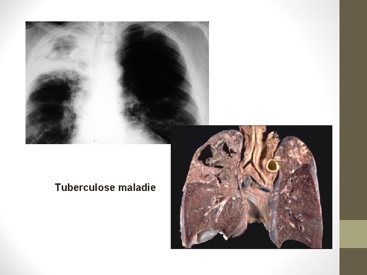 La Tuberculose cours IFSI 230920 Dr Anne Contis
