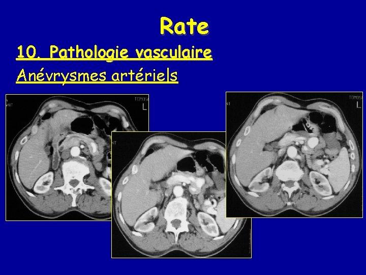 Imagerie de la rate DCEM 1 Imagerie de