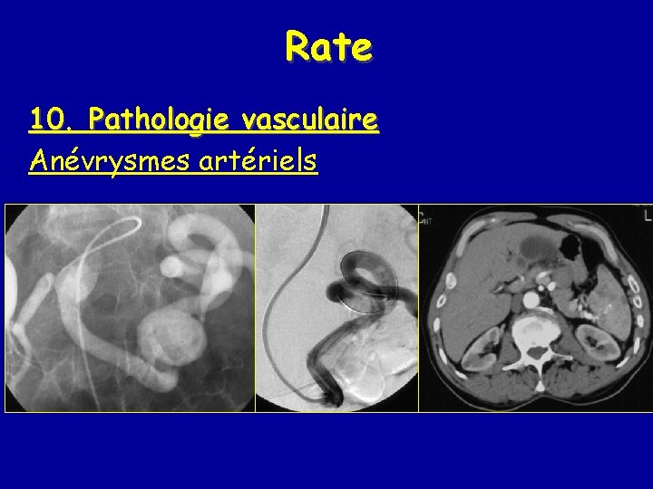 Imagerie de la rate DCEM 1 Imagerie de