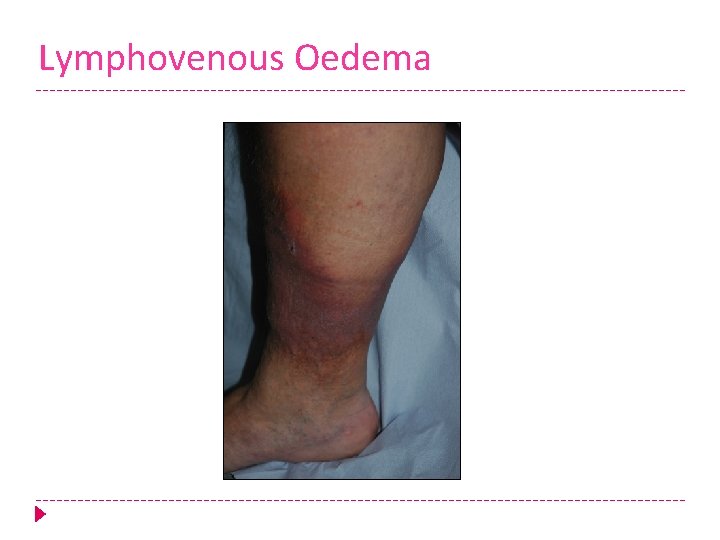 Managing Lower Limb Swelling Chronic Oedema and Lymphoedema