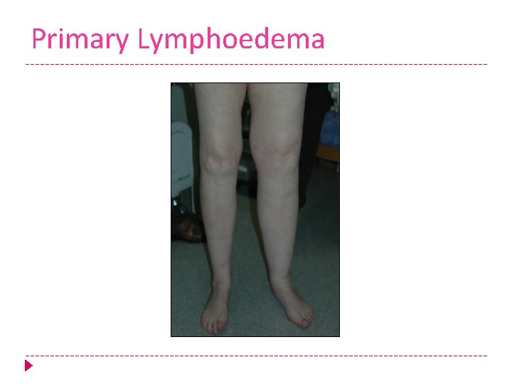 Managing Lower Limb Swelling Chronic Oedema and Lymphoedema