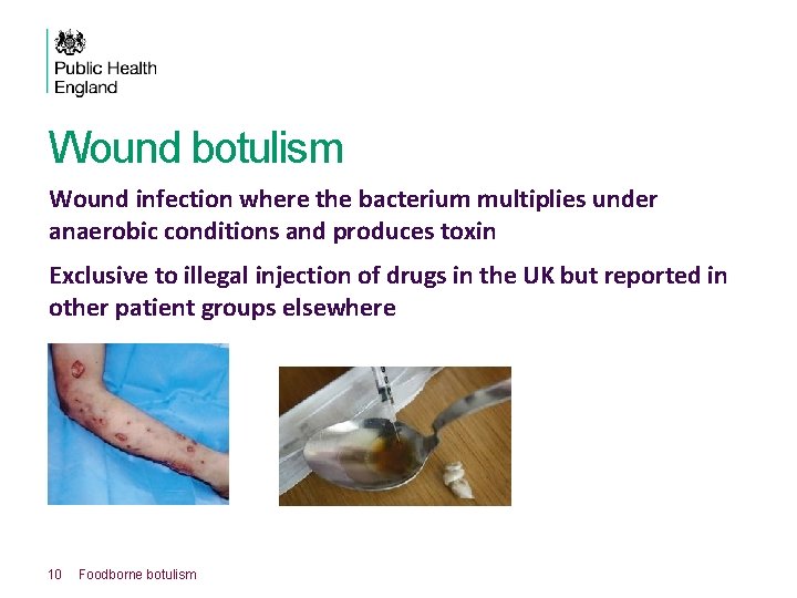 Foodborne Botulism or Please dont pass the olives