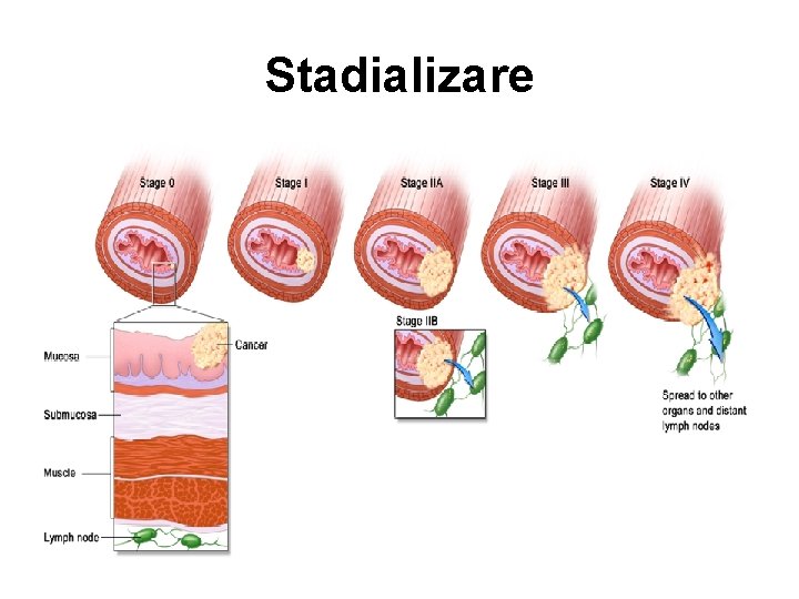 Cancere digestive Cancerul esofagian Epidemiologie carcinomul de esofag