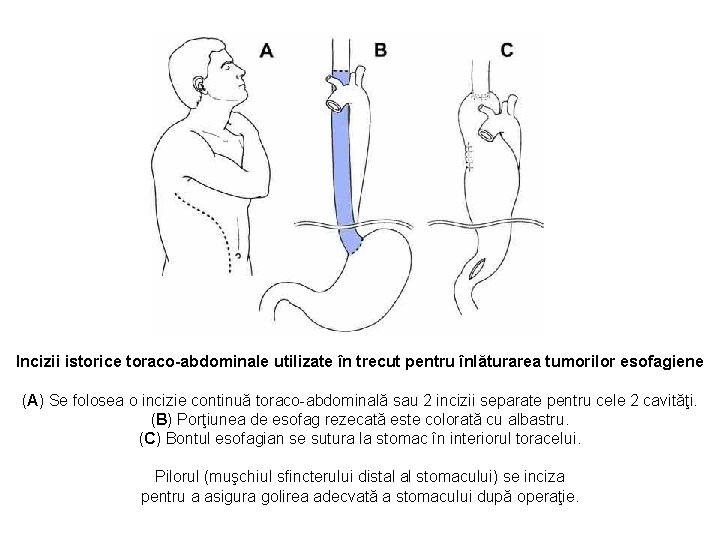 Cancere digestive Cancerul esofagian Epidemiologie carcinomul de esofag