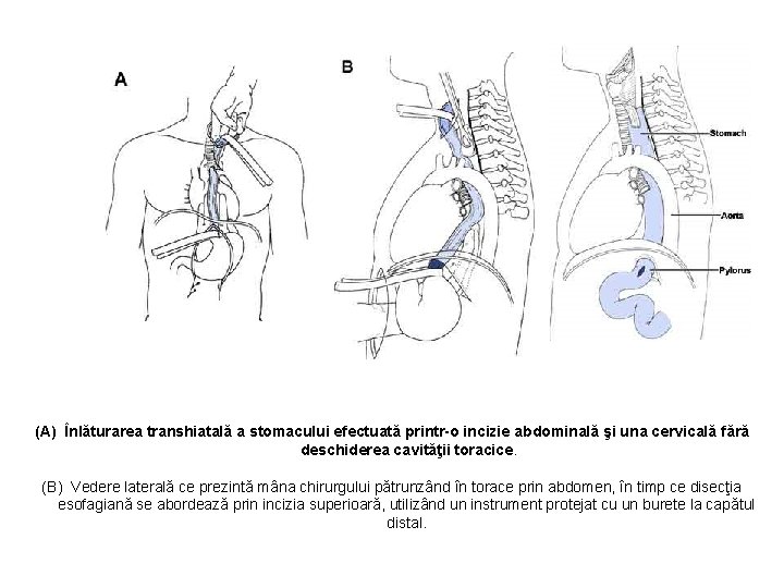 Cancere digestive Cancerul esofagian Epidemiologie carcinomul de esofag