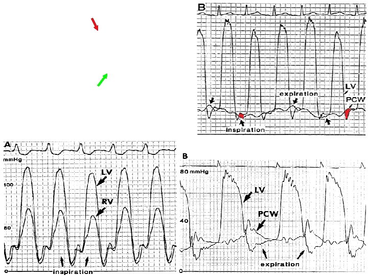 The Hemodynamics of Restrictive Constrictive Cardiomyopathy Jad Skaf