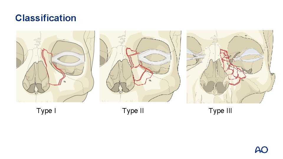 Nasoorbitoethmoidal NOE fractures Learning objectives Describe ...