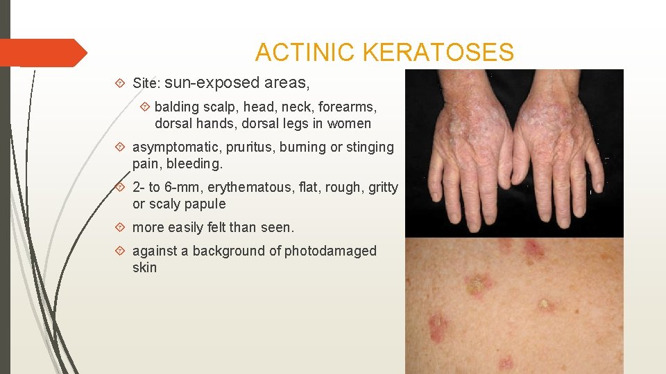 Pre Cancerous Lesions of the Skin Mucosa Neirita