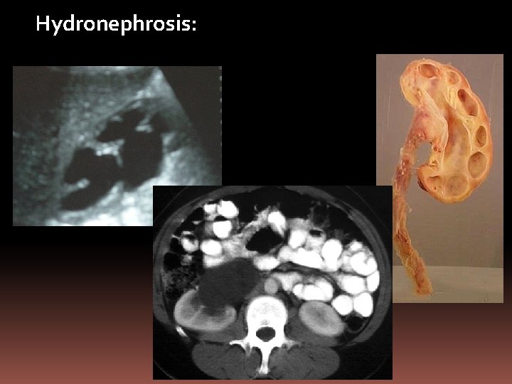 SIMPLE AND COMPLEX RENAL CYSTS By NourEldin A