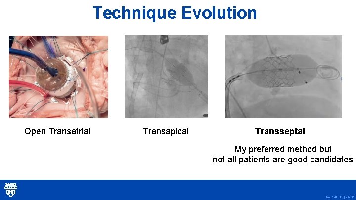 Implantation of BalloonExpandable THVs in Native Mitral Valve