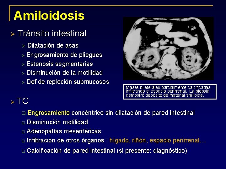 Amiloidosis Fisiopatologa Depsitos extracelulares de protena fibrilar AL