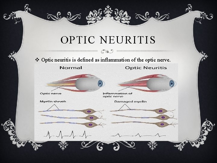 OPTIC NEURITIS DR ADNAN OPTIC NEURITIS v Optic