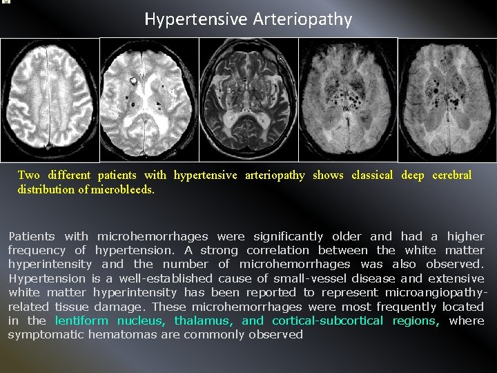 Cerebral Microbleeds Causes Clinical Relevance and Imaging Approach