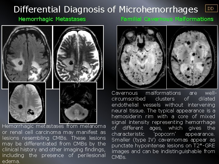 Cerebral Microbleeds Causes Clinical Relevance and Imaging Approach