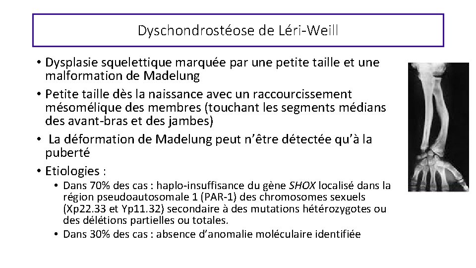 Translocation rciproque dsquilibre de novo entre le bras