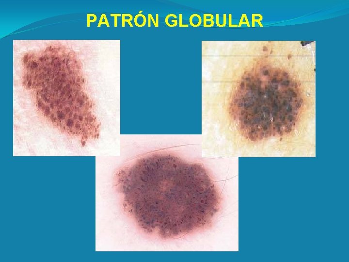SUMARIO PATRONES DERMATOSCPICOS 1 Definicin 2 Significado diagnstico
