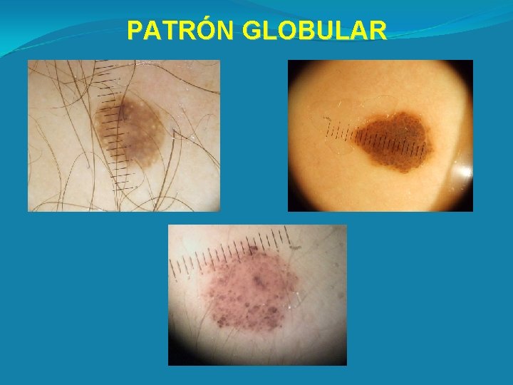 SUMARIO PATRONES DERMATOSCPICOS 1 Definicin 2 Significado diagnstico