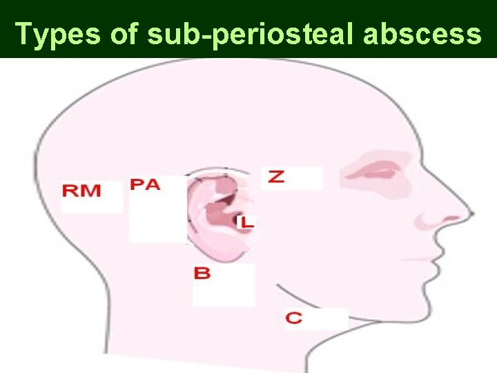 Acute Suppurative Otitis Media Dr Vishal Sharma Definition