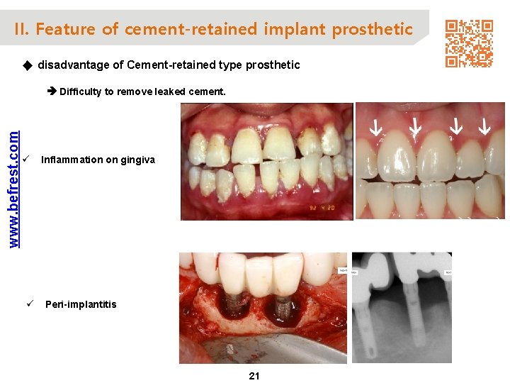 Classification of implant prosthetics 1 www befrest com