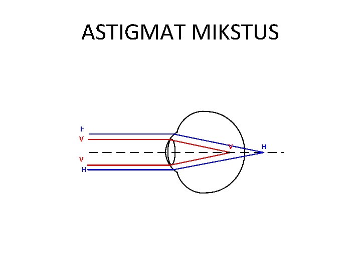 KELAINAN REFRAKSI BAGIAN I K MATA FAKULTAS KEDOKTERAN