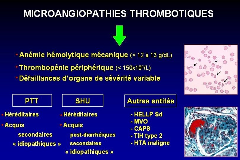 MICROANGIOPATHIES THROMBOTIQUES PHYSIOPATHOLOGIE CLASSIFICATION Paul ...