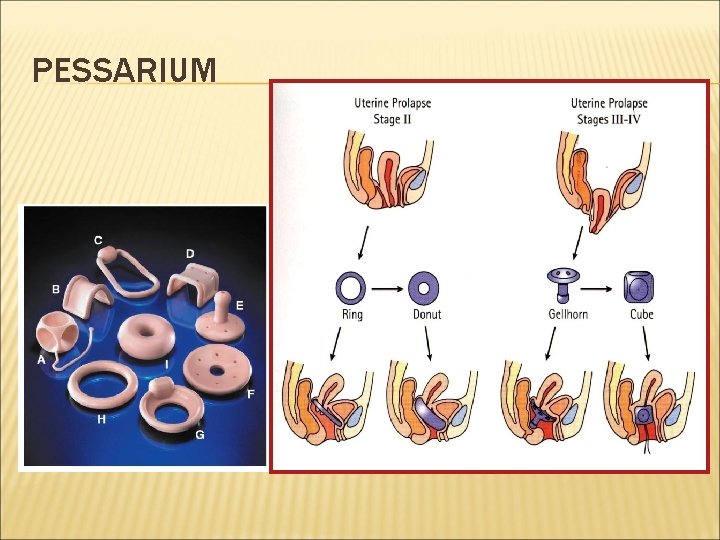 PROLAPSUS UTERI BAGIAN ILMU OBSTETRI DAN GINEKOLOGI FAKULTAS