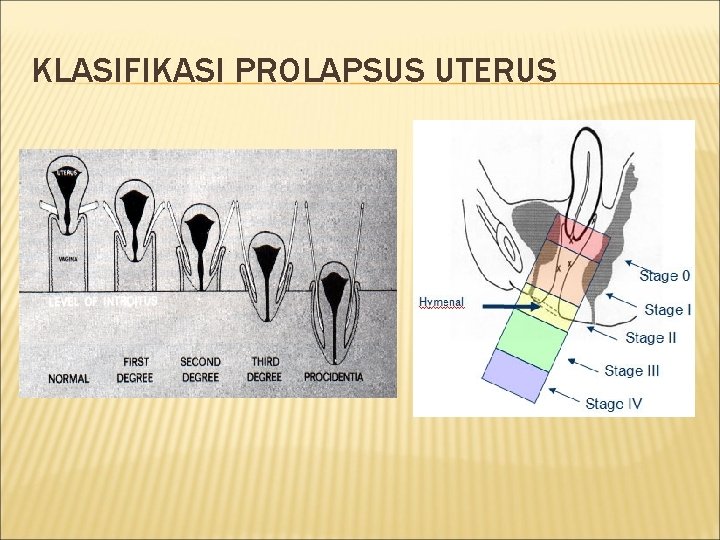 PROLAPSUS UTERI BAGIAN ILMU OBSTETRI DAN GINEKOLOGI FAKULTAS