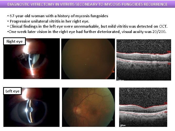 DIAGNOSTIC VITRECTOMY IN VITRITIS SECONDARY TO MYCOSIS FUNGOIDES