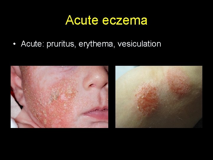 Atopic Eczema Sharon Wong Suzy Tinker Classification Endogenous