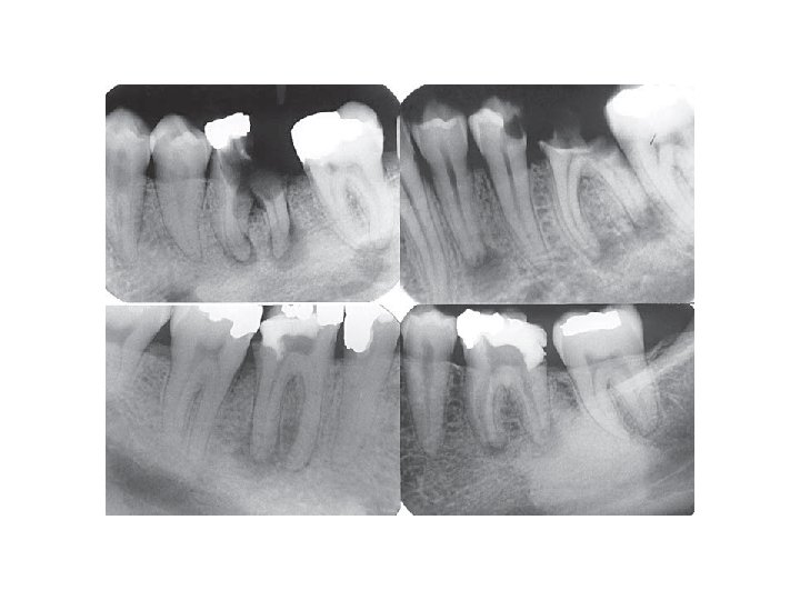 Apikale Parodontitis Definitionen Odontium Zahnschmelz Dentin Pulpa Apikale